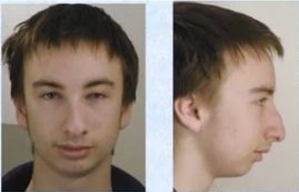 Op een natuurlijke manier een scheve neus en tanden voorkomen. - Beter ...