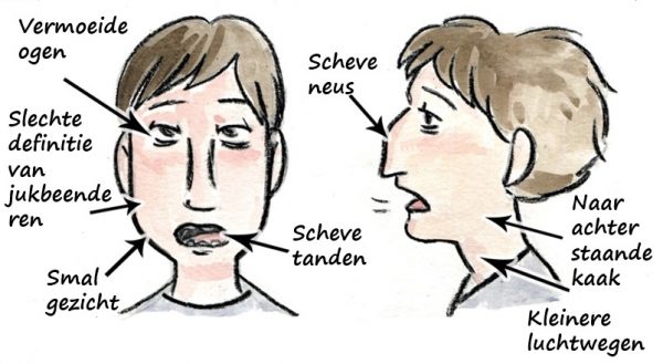Hoe je een scheve neus en tanden kunt voorkomen. - Beter ademen bij ziekte.