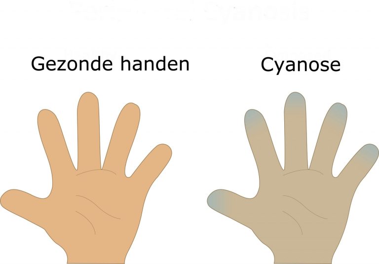 Cyanose - Blauwzucht - Behandeling cyanose - Perifere cyanose