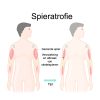 Spieratrofie - Spieratrofie betekenis - Spieratrofie behandeling