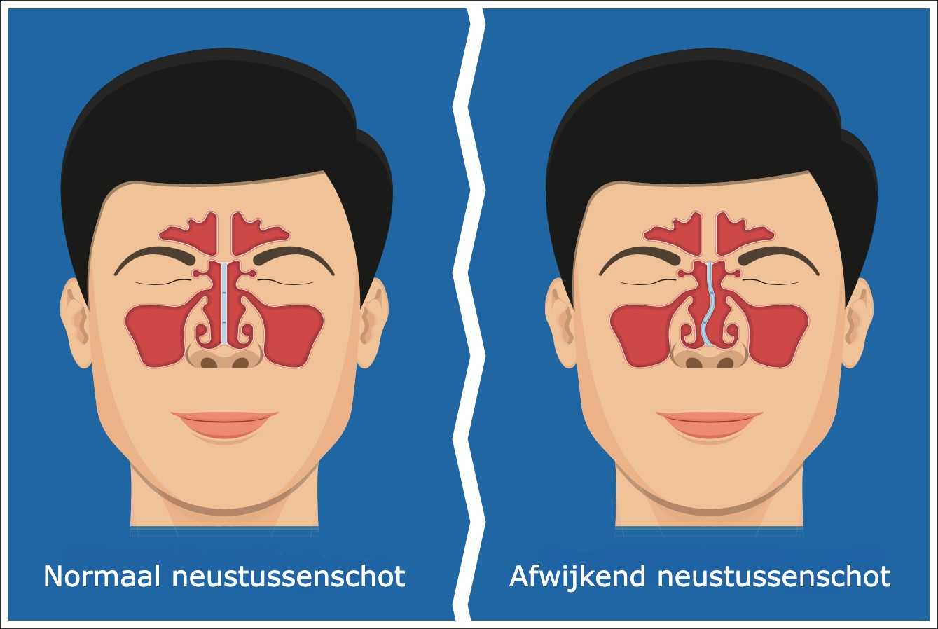Neustussenschot scheef door klap